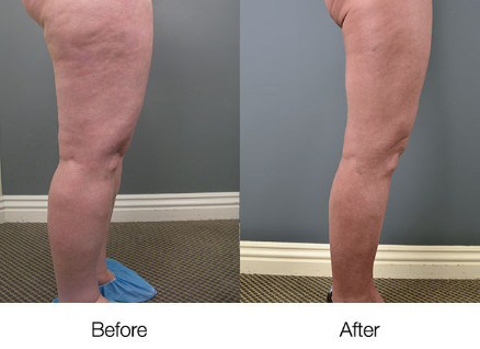 Lipedema Treatment Power Assisted Liposuction Equipment (PAL SYSTEM)