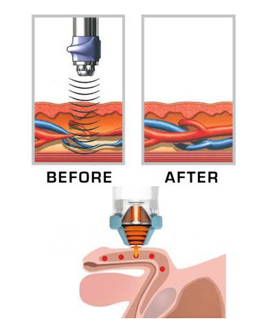 Erectile Dysfunction Ed1000 Gainswave Shockwave Therapy Equipment
